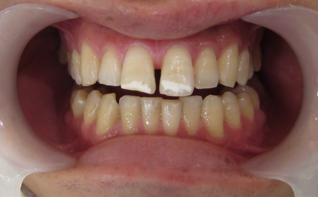 審美歯科ティーススタジオ ｜ ホワイトスポット すきっ歯